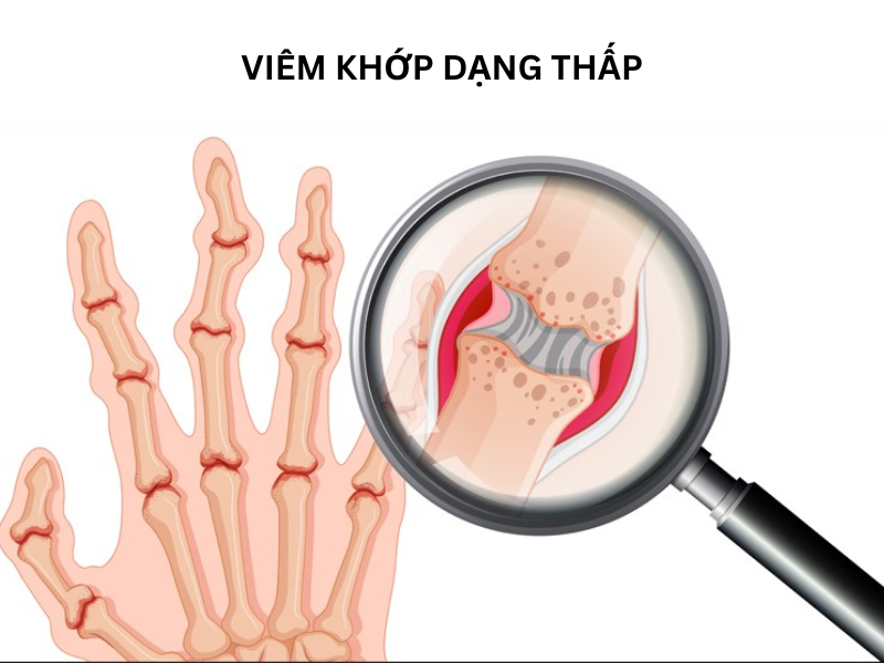 Vitamin B12 trong hỗ trợ điều trị viêm khớp dạng thấp - Bepharco